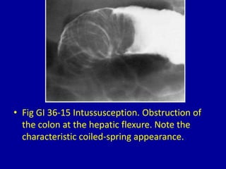 36 filling defects in the colon | PPTX | Digestive Disorders | Diseases ...