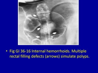 36 filling defects in the colon | PPTX | Digestive Disorders | Diseases ...