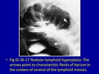 36 filling defects in the colon | PPTX | Digestive Disorders | Diseases ...