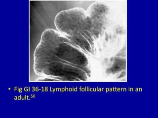 36 filling defects in the colon | PPTX