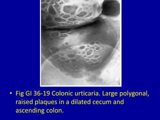 36 filling defects in the colon | PPTX | Digestive Disorders | Diseases ...