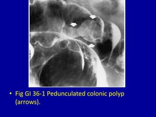36 filling defects in the colon | PPTX | Digestive Disorders | Diseases ...