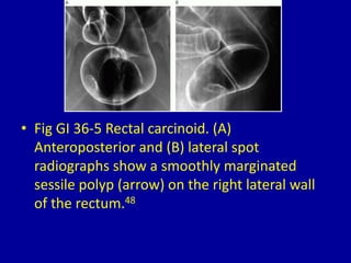 36 filling defects in the colon | PPTX