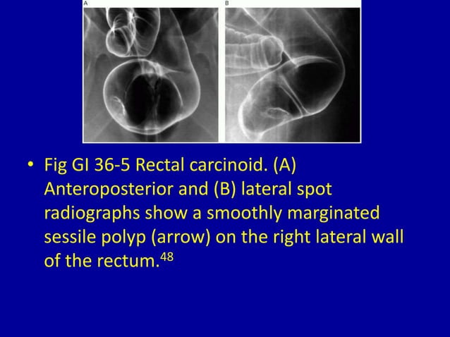 36 filling defects in the colon | PPT