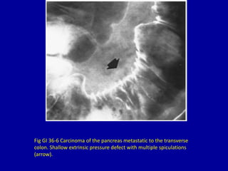 36 filling defects in the colon | PPTX