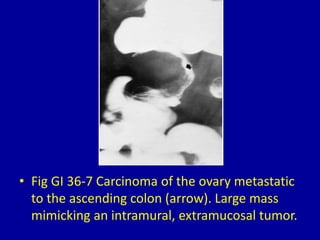 36 filling defects in the colon | PPTX