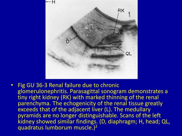 36 focal or diffuse distortion of normal renal | PPTX