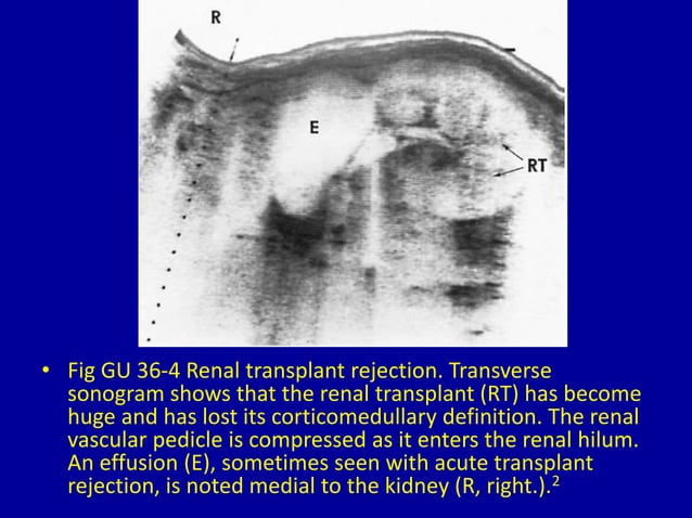 36 focal or diffuse distortion of normal renal | PPTX