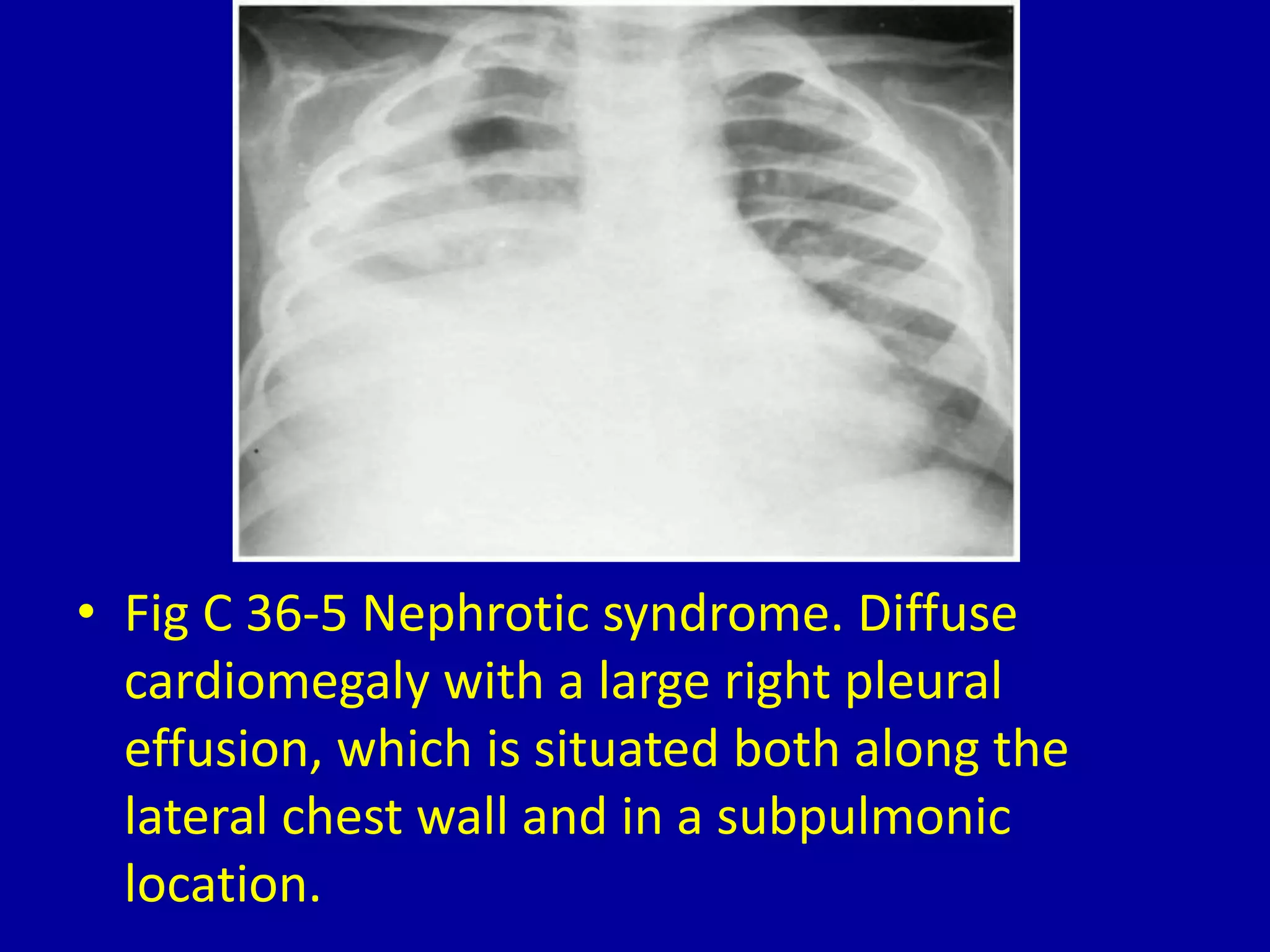 36 pleural effusion with otherwise normal appearing chest | PPT