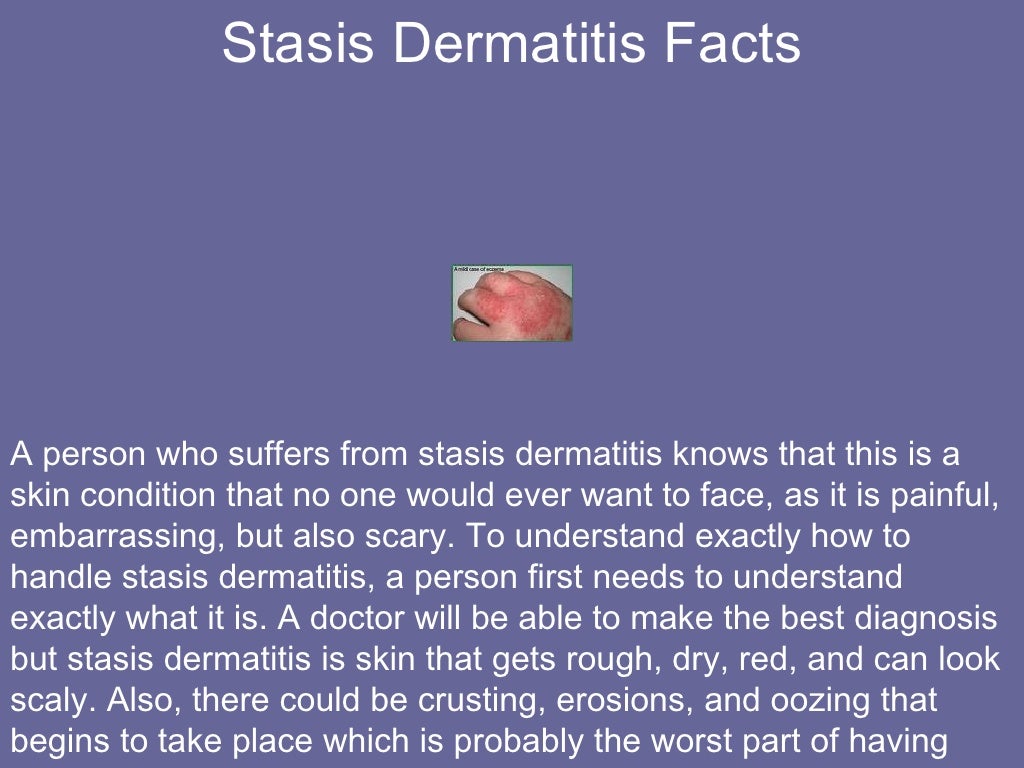 Stasis Dermatitis Causes