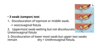 36; subinvulution of uterus, rectovaginal fistula, vacicovaginal ...