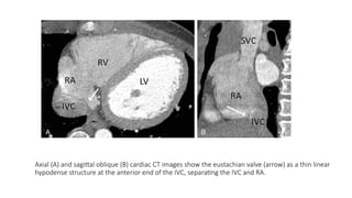 37.imaging of cardiac anatomy and pericardium.pptx