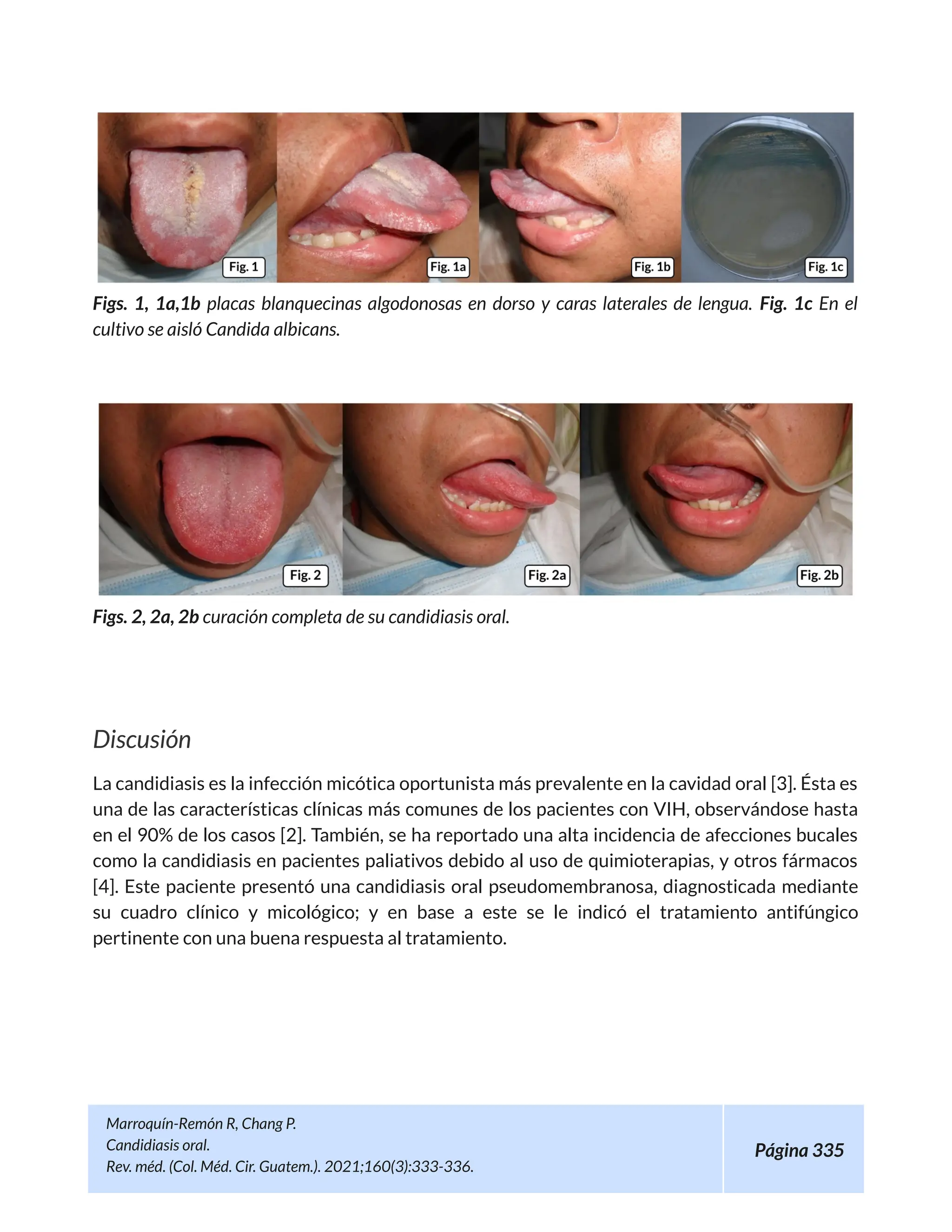 370+-+Candidiasis+oral+-+v160i3-LO-V001 (1).pdf