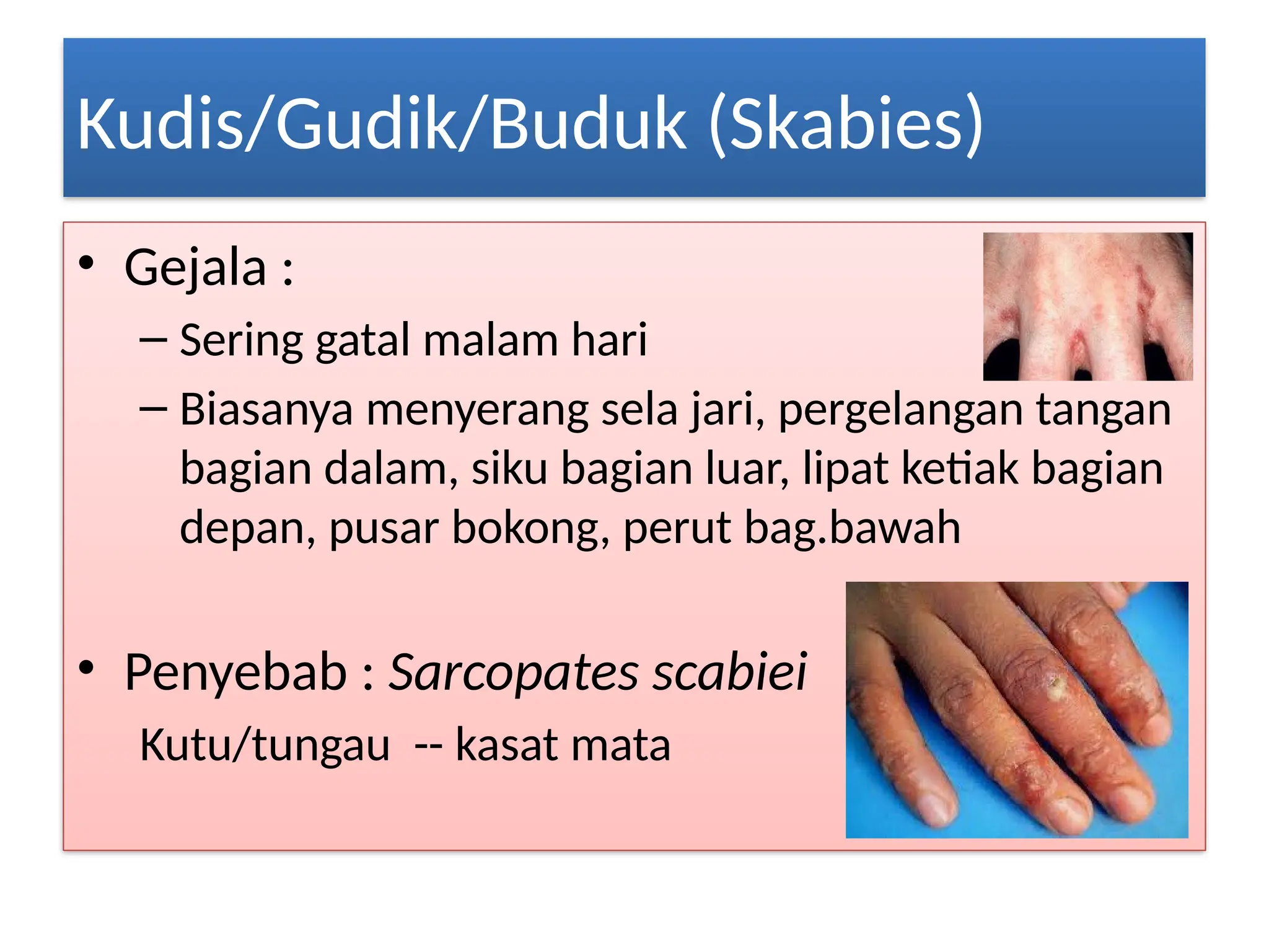 PENYAKIT-KULIT. kadas kurap panu exemepptx | PPT