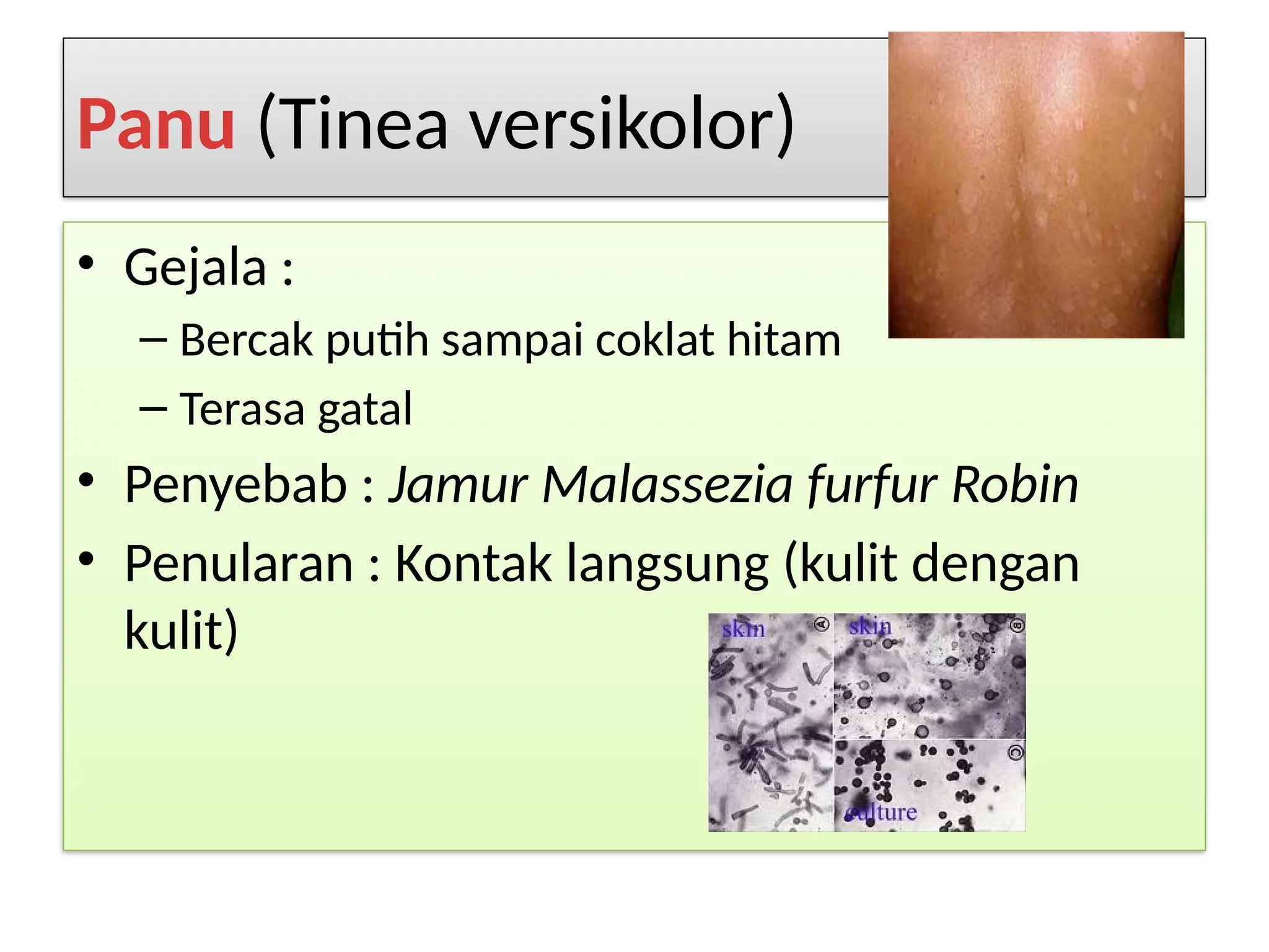 PENYAKIT-KULIT kurap gatal [Autosaved].pptx