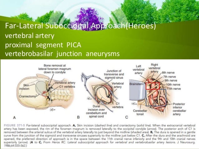 371 Microsurgery of VA PICA VBJ aneurysm