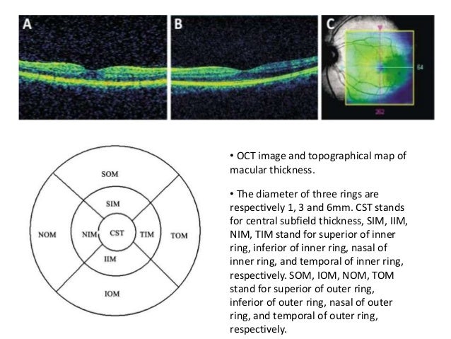 Retinal Thickness In Macular Region Of High Myopic Eyes Using Sd-Oct