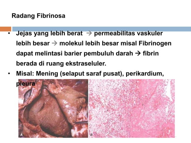 Konsep Inflamasi dan peradangan pada perawat | PPTX