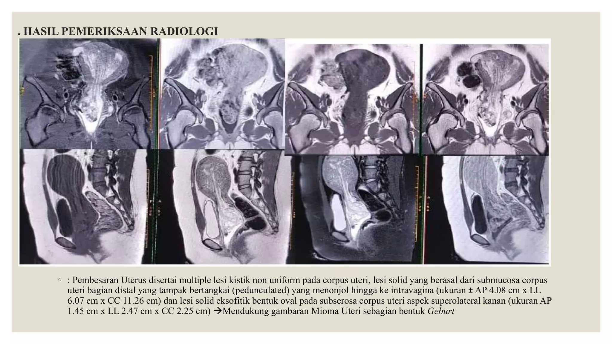 372509570-Gambaran-Radiologi-Mioma-Uteri.pptx