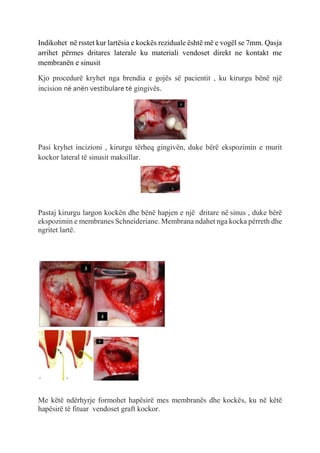 376116825-7-Sinus-Lifting.docx