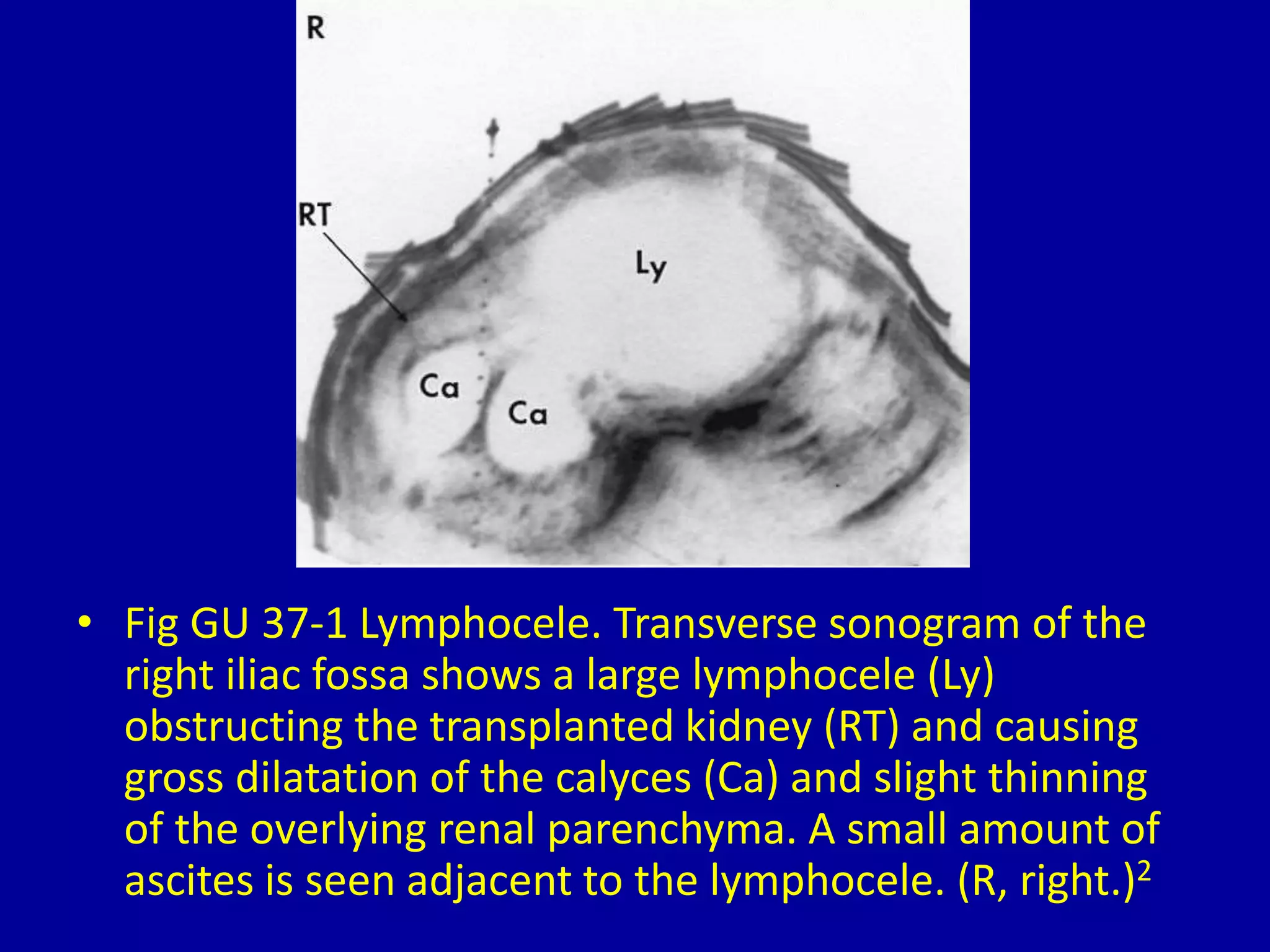 37 fluid collections around the transplanted kidney | PPT