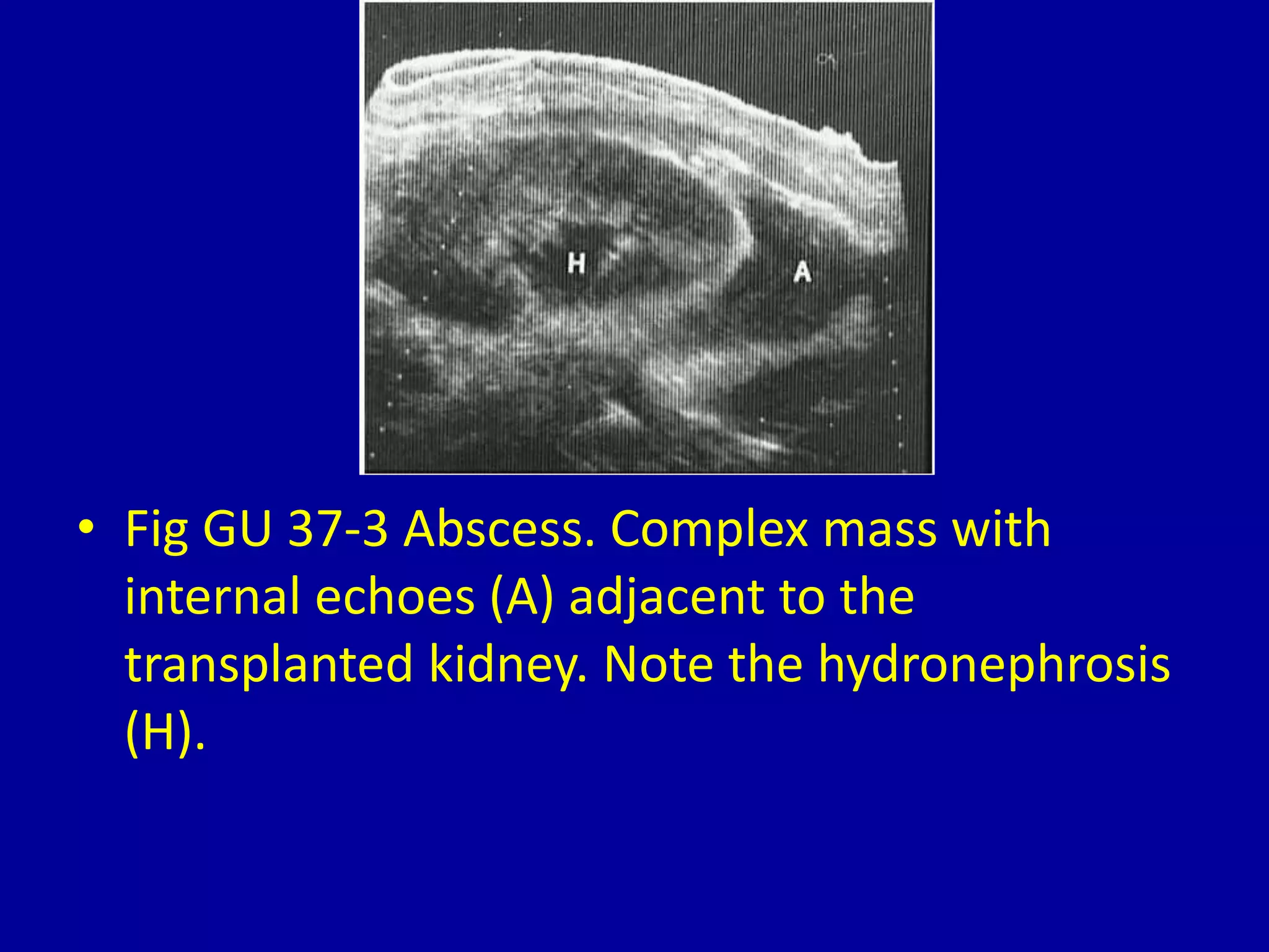 37 fluid collections around the transplanted kidney | PPTX