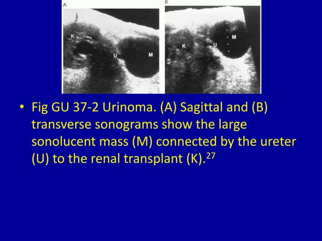 37 fluid collections around the transplanted kidney | PPTX