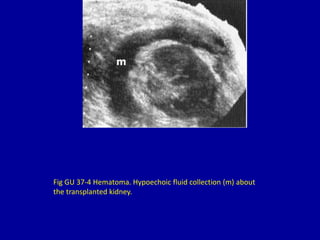37 fluid collections around the transplanted kidney | PPTX