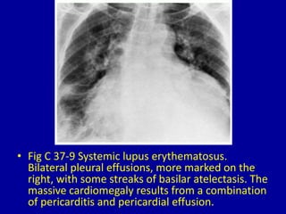 37 pleural effusion associated with other radiographic evidence | PPT