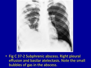 37 pleural effusion associated with other radiographic evidence | PPT