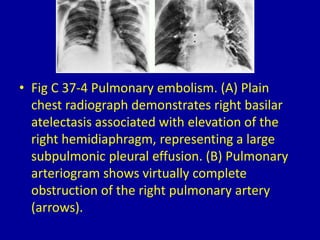 37 pleural effusion associated with other radiographic evidence | PPT