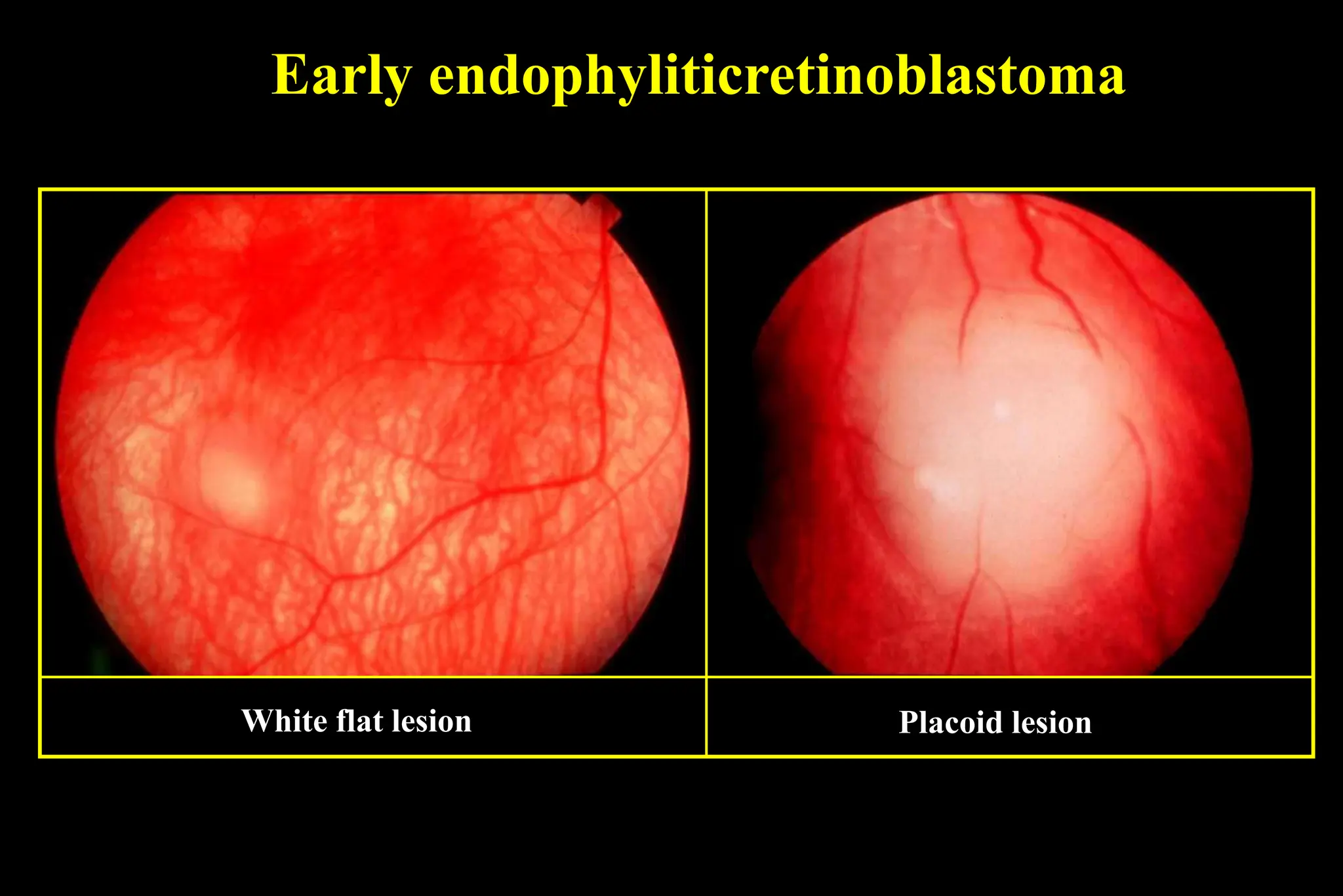 Retinoblastoma.ppt