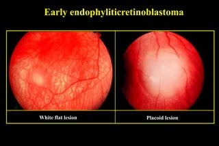 Retinoblastoma.ppt