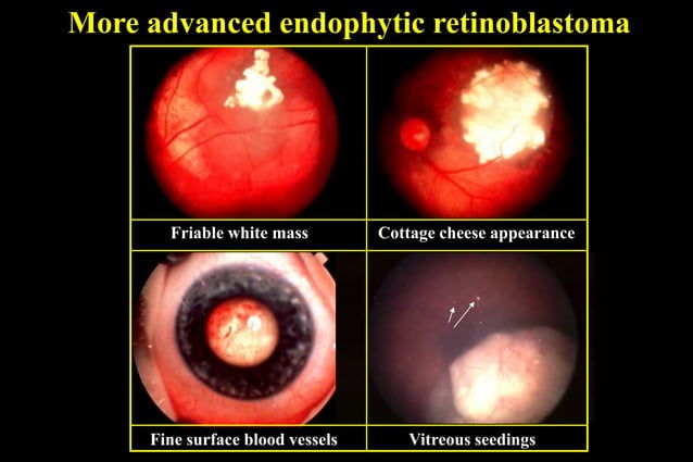 Retinoblastoma.ppt