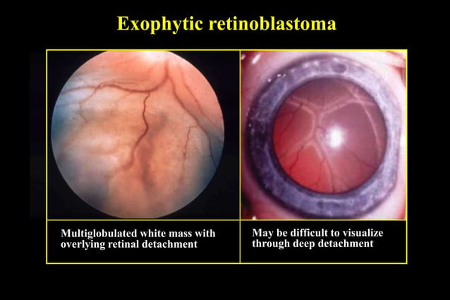 Retinoblastoma.......................ppt | Free Download