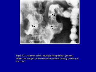 37 thumbprinting of the colon | PPTX