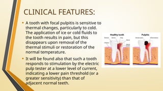 Pulpitis classification Oral Pathology.pptx