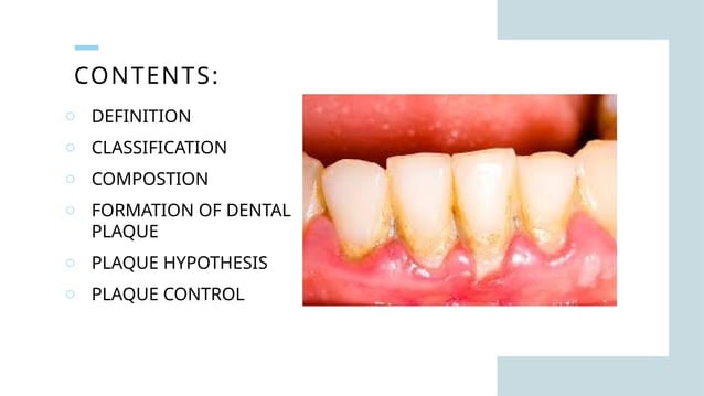 38.Dental Plaque Periodontology .pptx