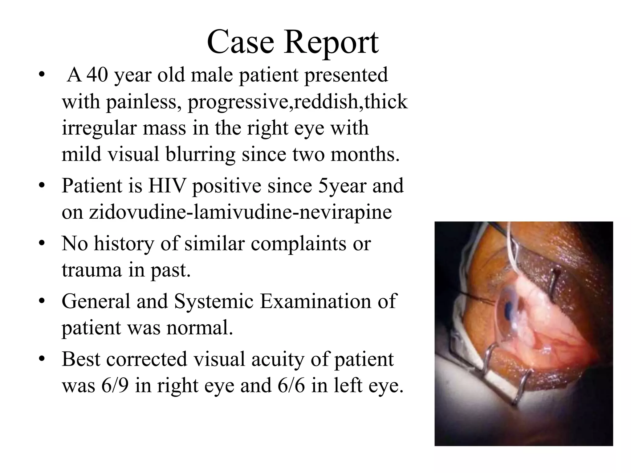 Surgical Excision Of Limbal Squamous Cell Carcinoma With Cryotherapy ...