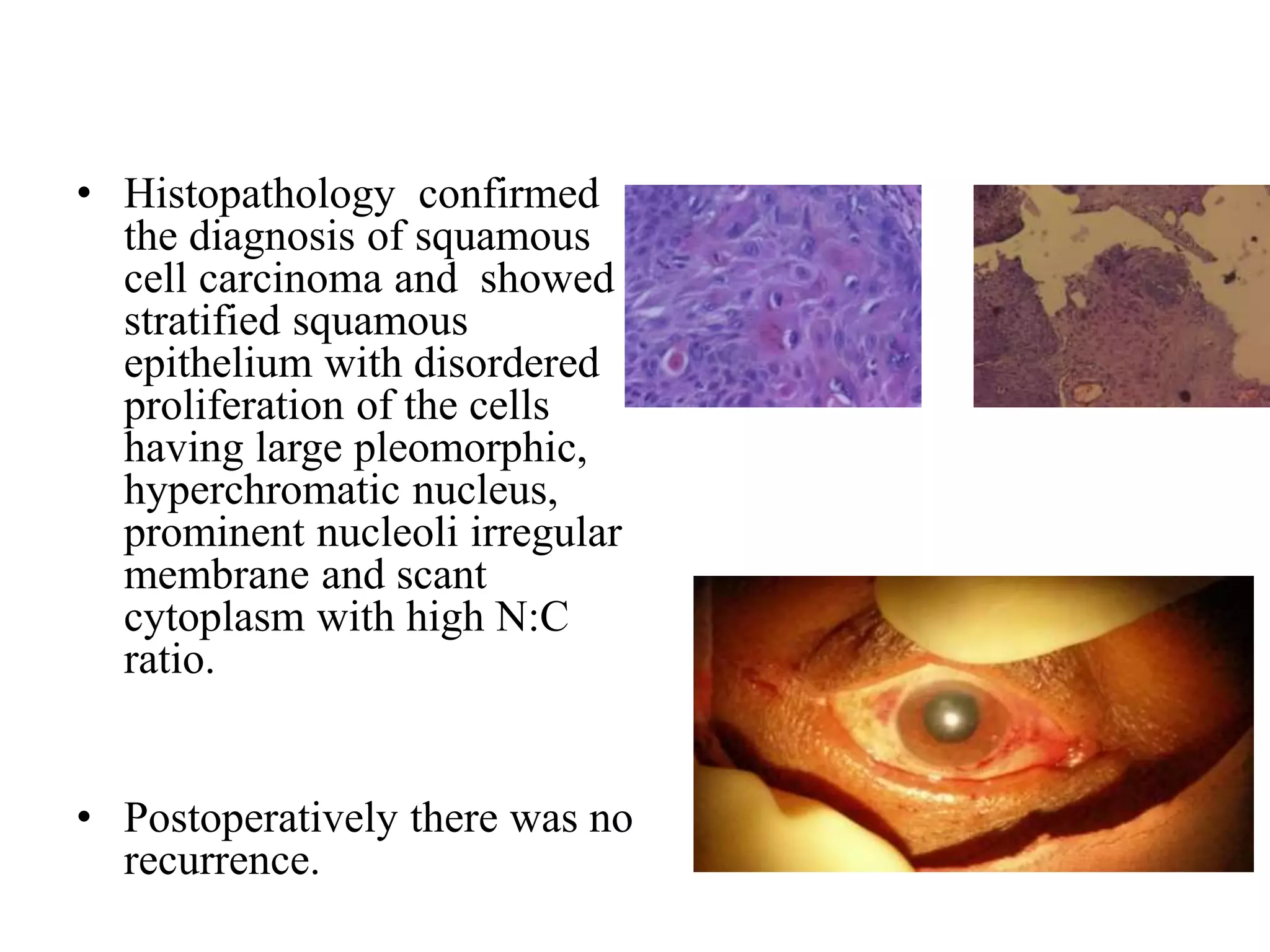 Surgical Excision Of Limbal Squamous Cell Carcinoma With Cryotherapy ...