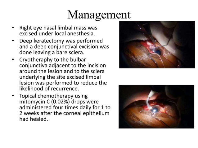 Surgical Excision Of Limbal Squamous Cell Carcinoma With Cryotherapy ...