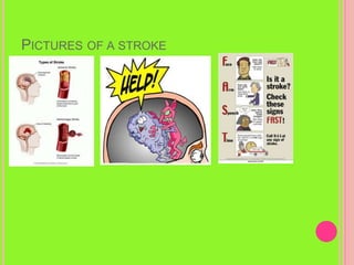 STROKE.ppt