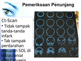 Diagnosis dan Tatalaksana Parese Nervus III | PPTX