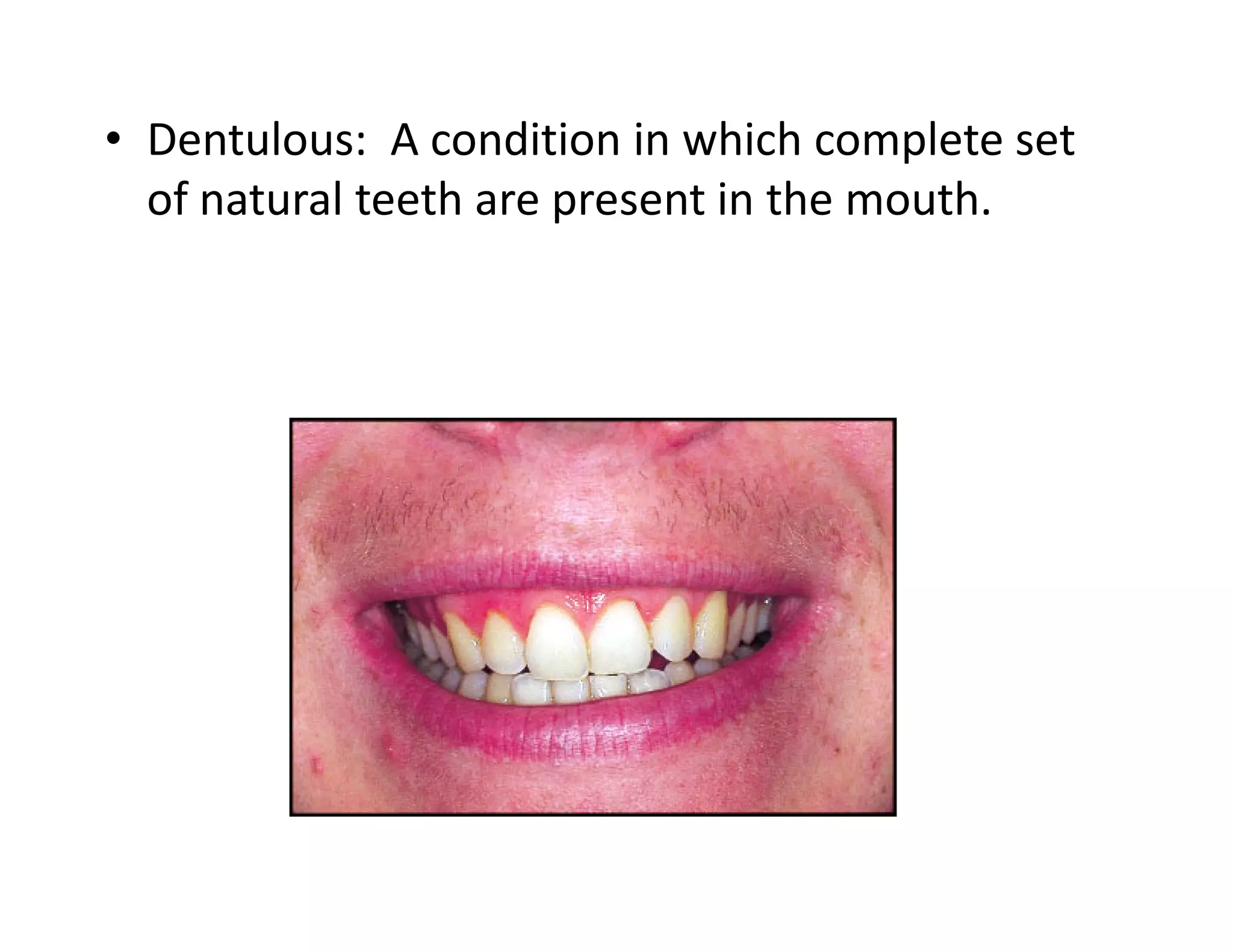 anatomy-for-complete-denture | PDF