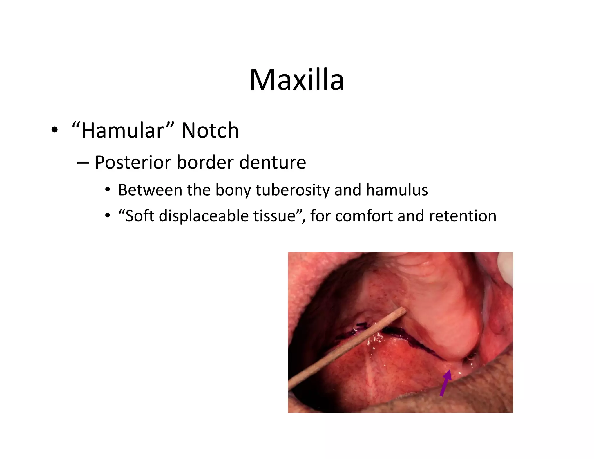 anatomy-for-complete-denture | PDF