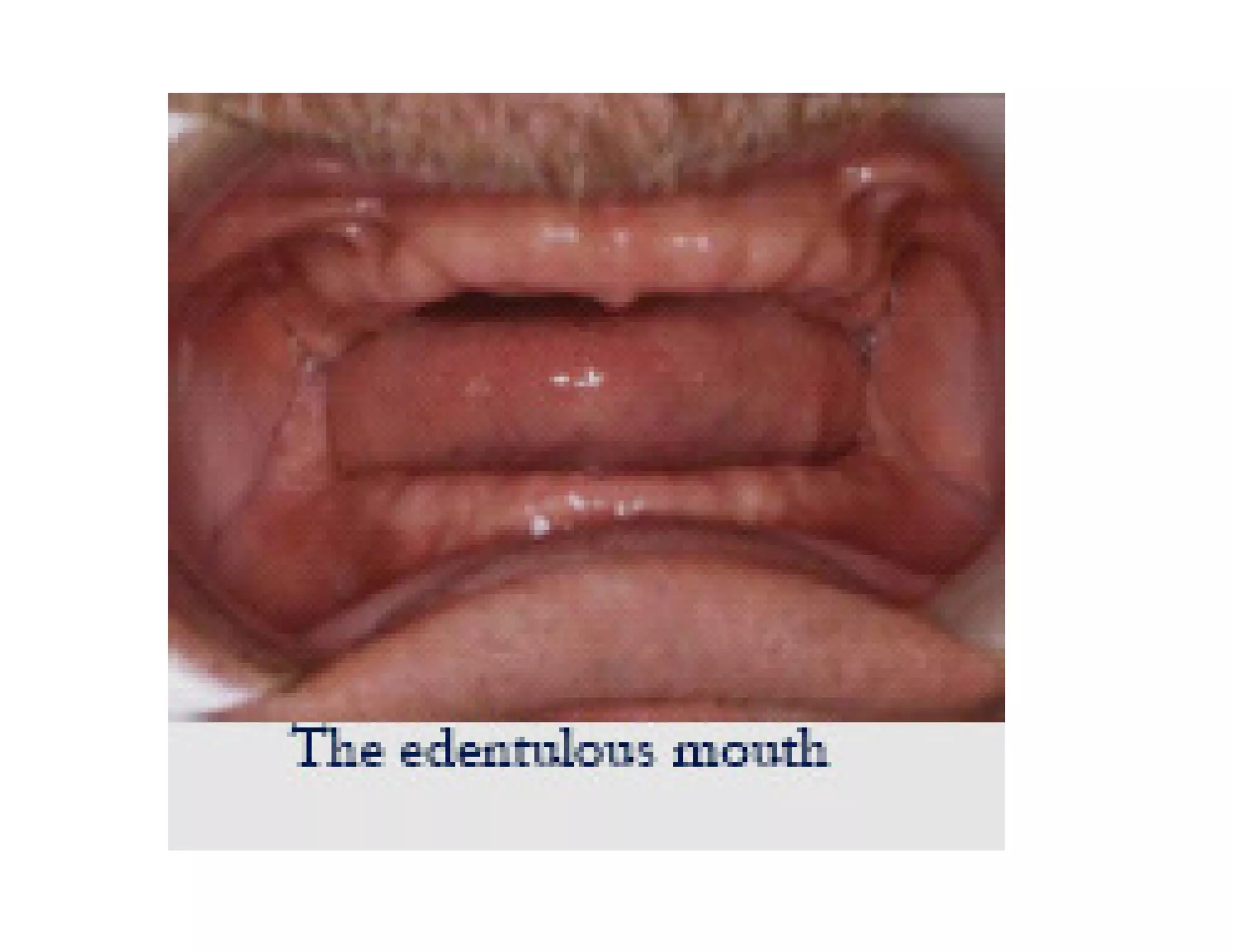 anatomy-for-complete-denture | PDF