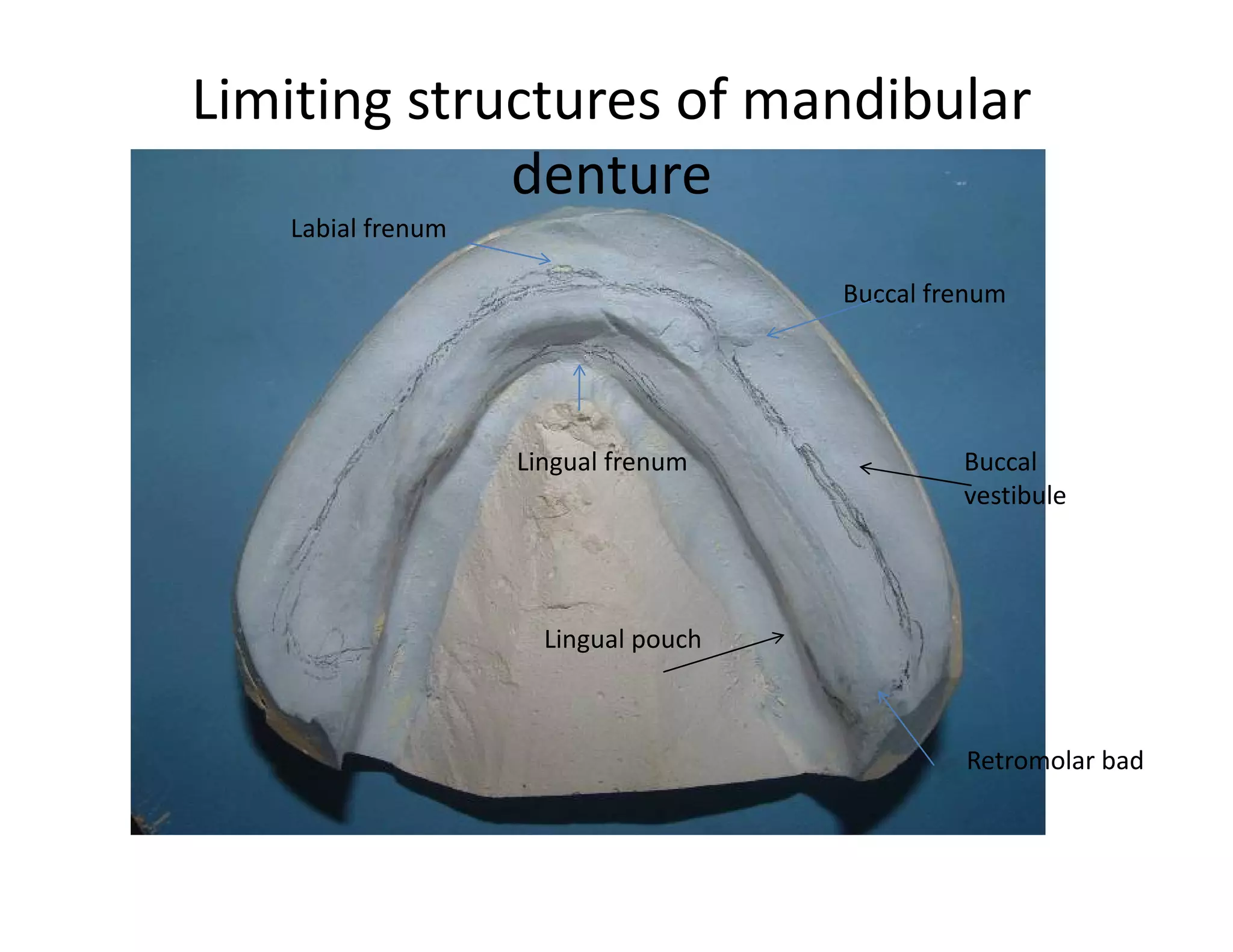 anatomy-for-complete-denture | PDF