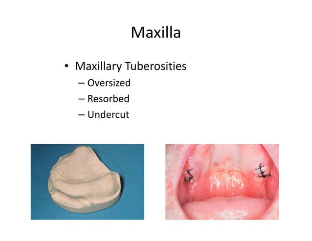 anatomy-for-complete-denture | PDF
