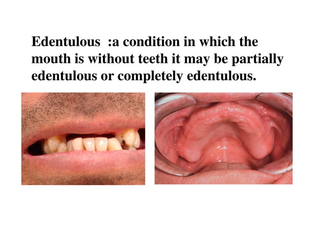 anatomy-for-complete-denture | PPT