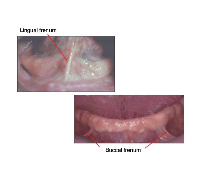 anatomy-for-complete-denture